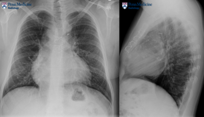 34-year-old man presenting for follow-up imaging after cardiac surgery ...