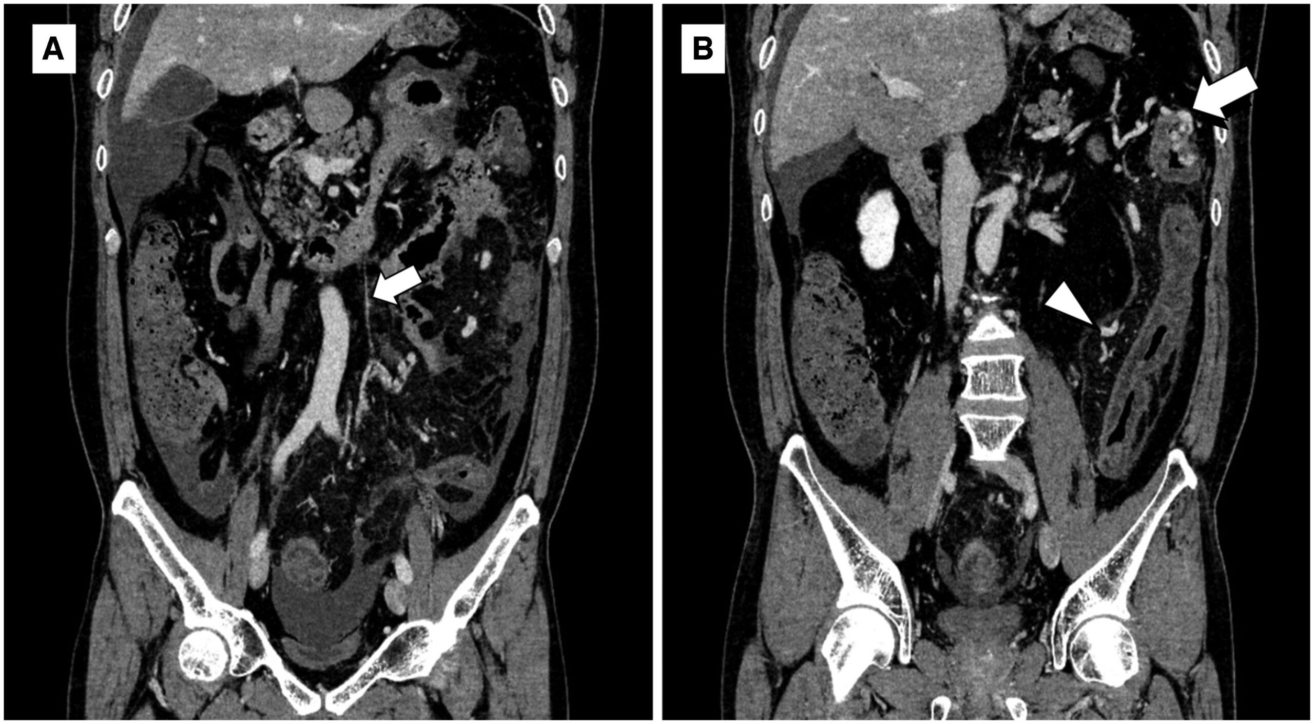 44-year-old man with constipation - myAuntminnie