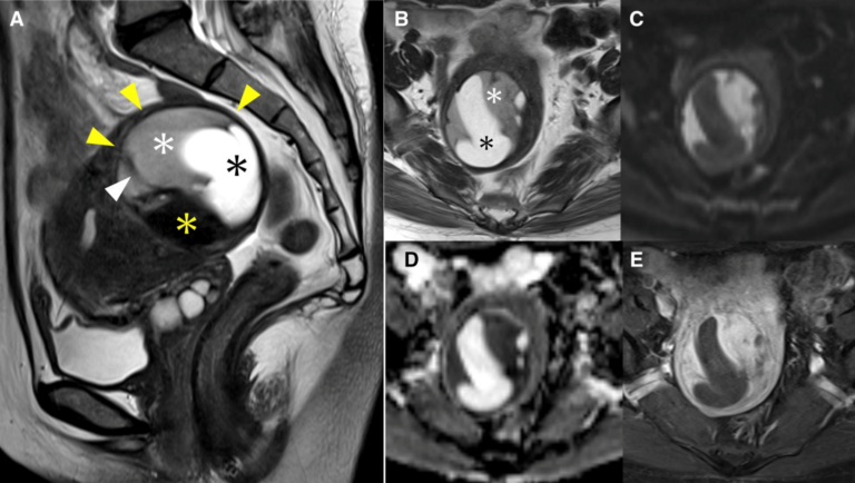 51-year-old woman with abnormal uterine bleeding - Auntminnie