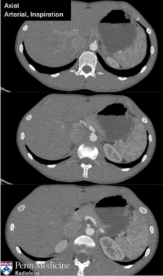 19-year-old man with chronic abdominal pain, bloating, and chest ...