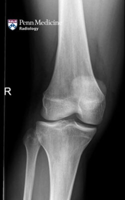 23-year-old man with knee pain and swelling after acute injury ...
