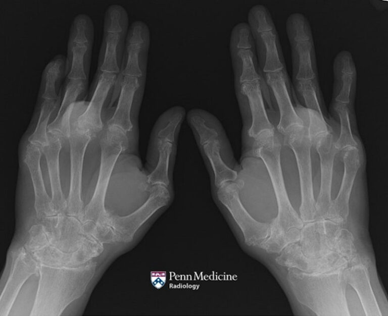 60-year-old man with acute-on-chronic bilateral hand pain - myAuntminnie