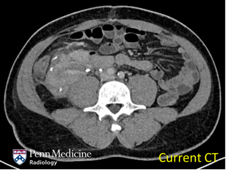 40-year-old man with right abdominal pain and vomiting - myAuntminnie