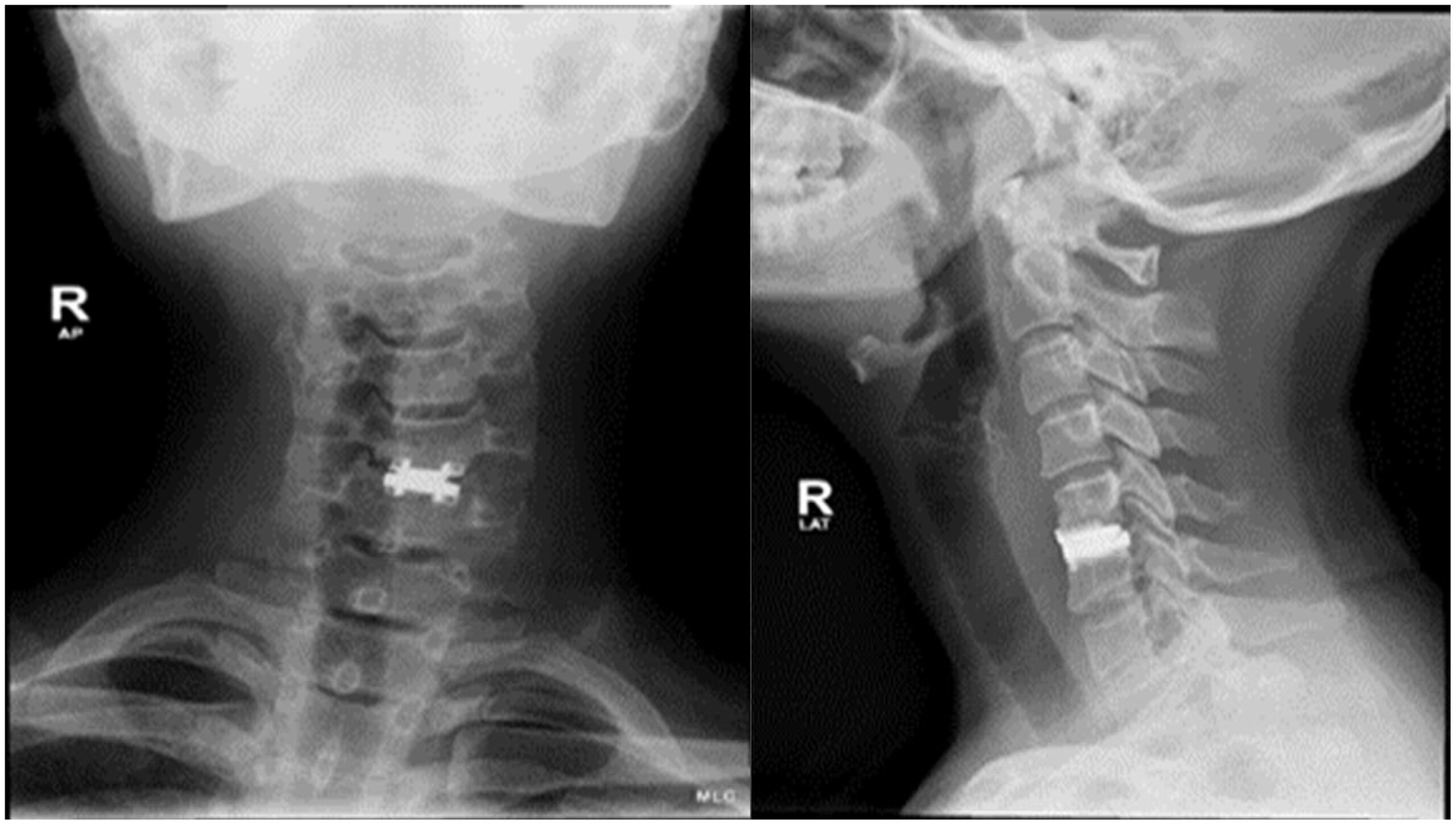 34-year-old woman with enlarging mass on left side of neck - myAuntminnie