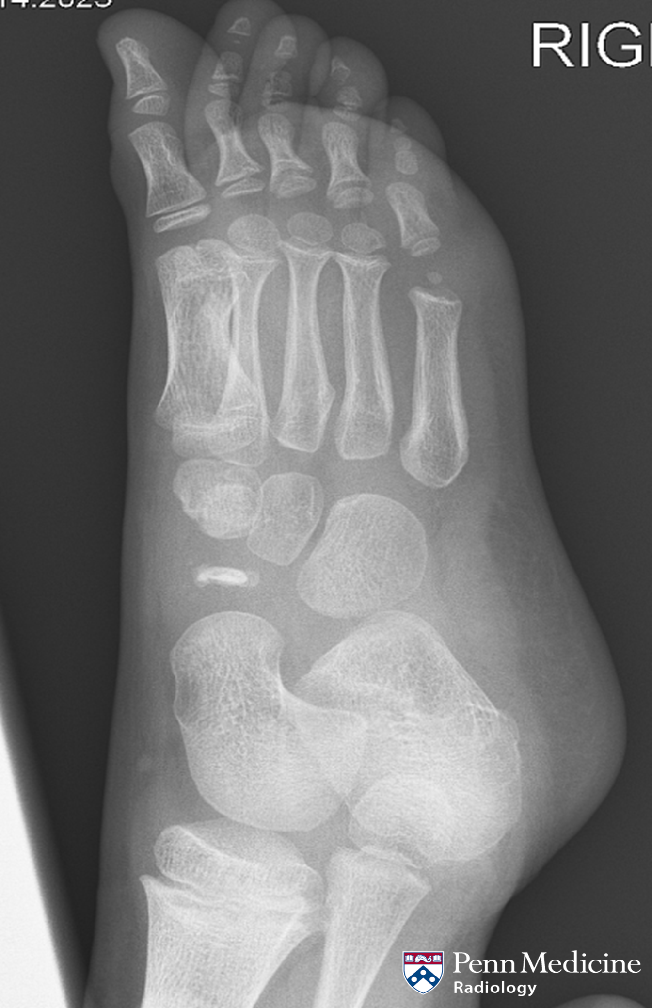 4-year-old boy with swollen foot and limping - myAuntminnie