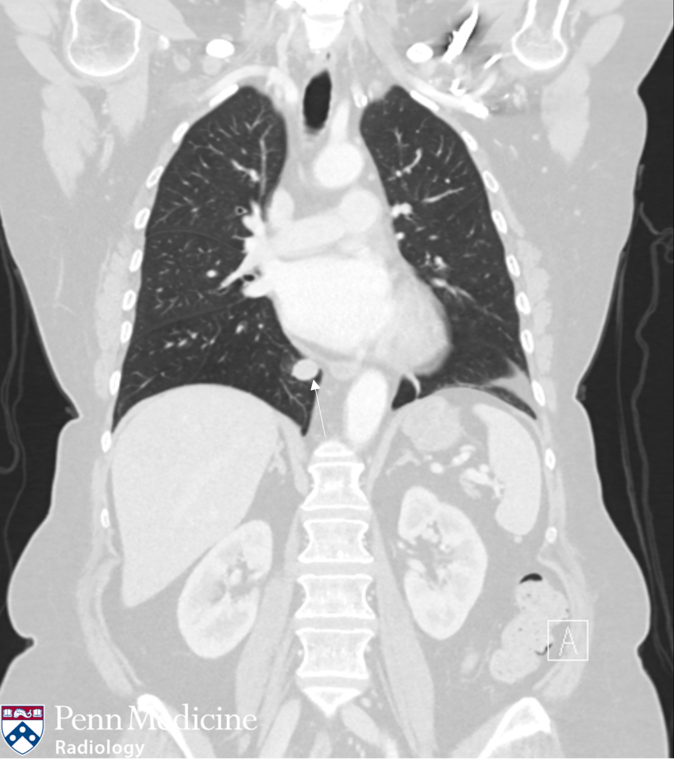 71-year-old woman with diarrhea and flushing - myAuntminnie