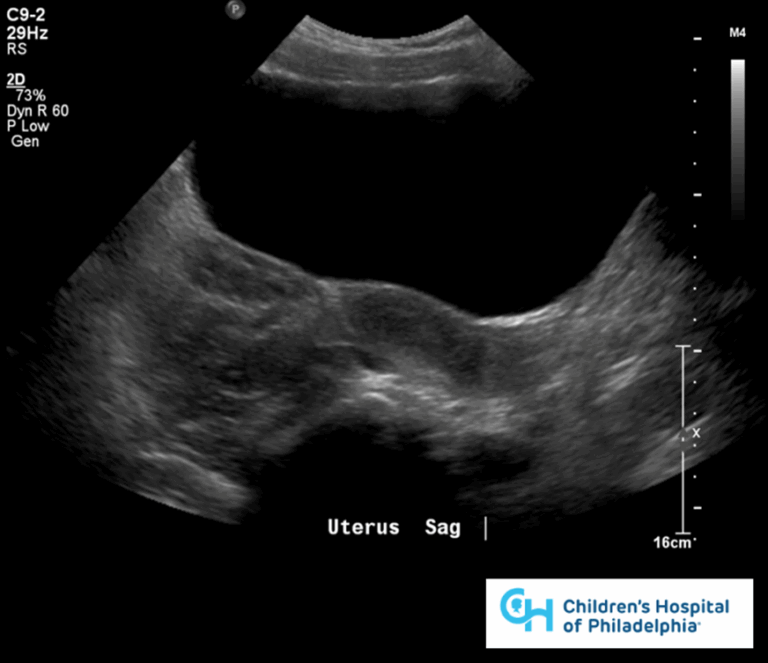 13-year-old girl with cyclic menses-associated abdominal pain ...