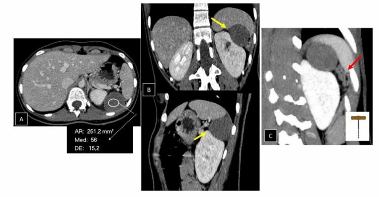 19-year-old woman with left-sided flank pain - myAuntminnie