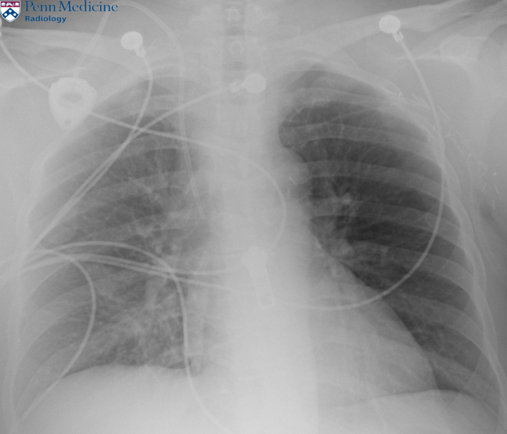 43-year-old woman with upper-body swelling - Auntminnie