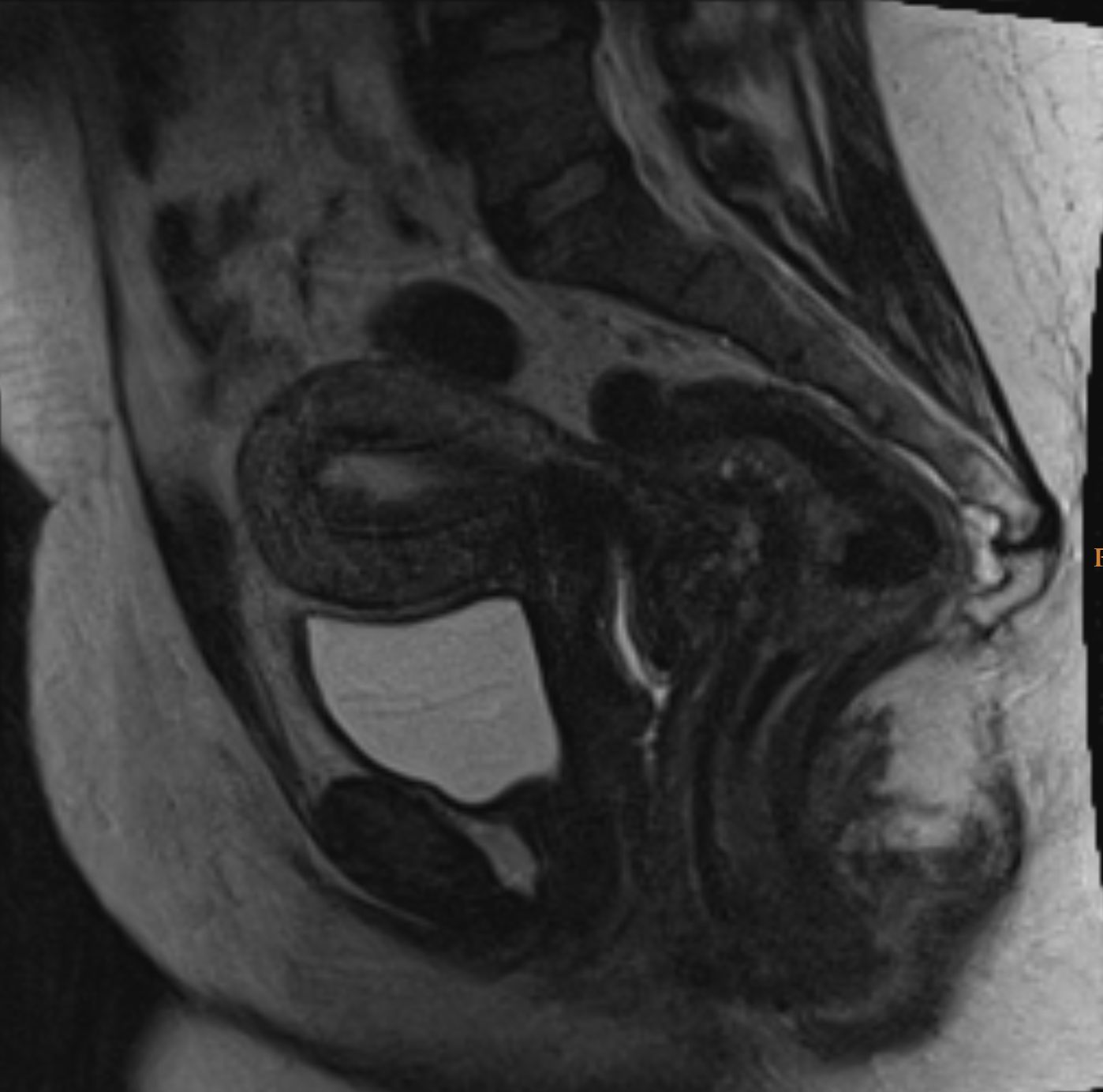30 year old Woman With Rectal Pain Auntminnie