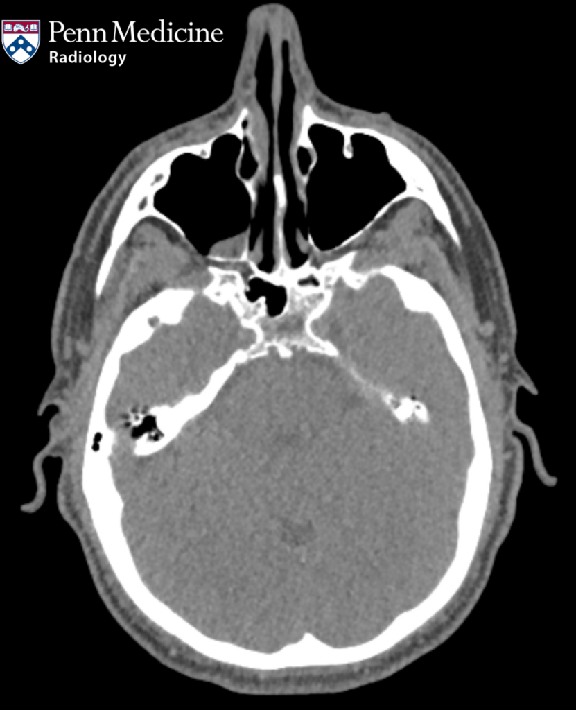 61-year-old man with incidental CT finding - Auntminnie